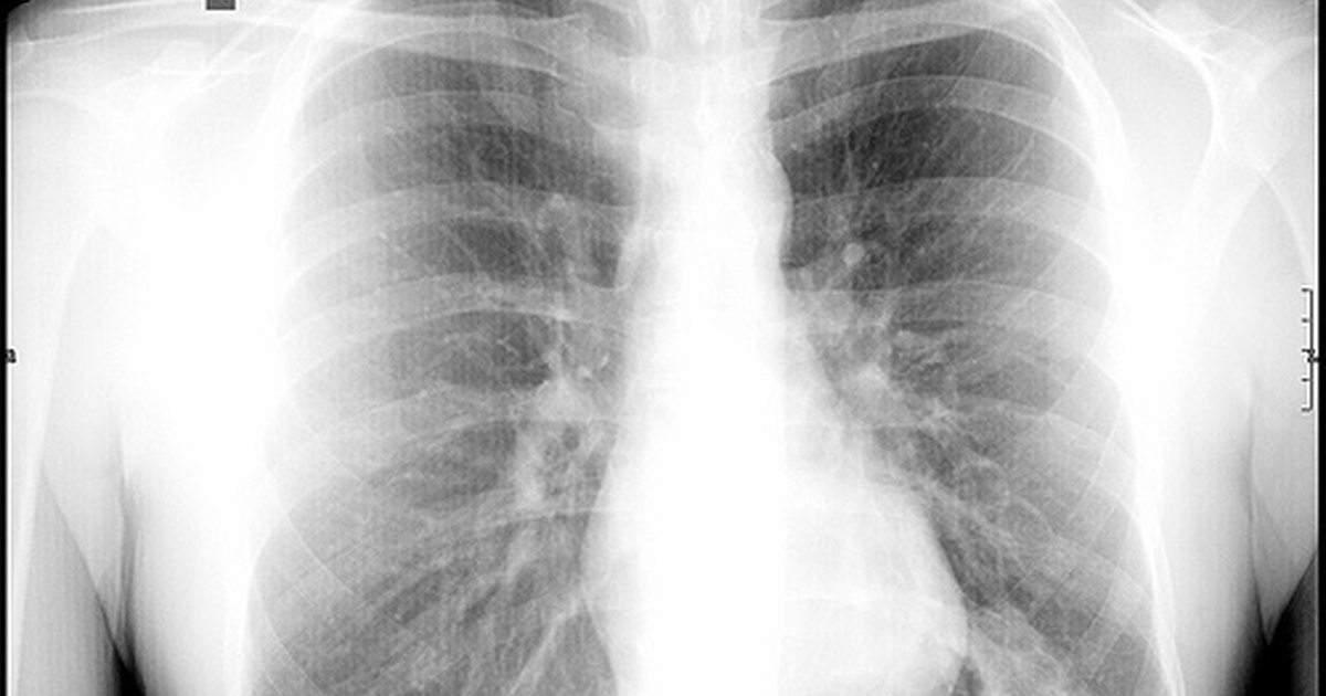 Chest Congestion Symptoms Ehow Uk